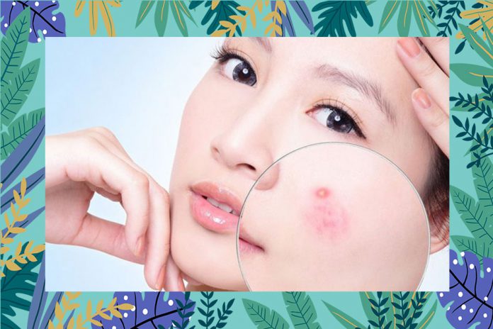 [Giải mã] Vị trí mọc mụn báo hiệu vấn đề sức khỏe như thế nào?